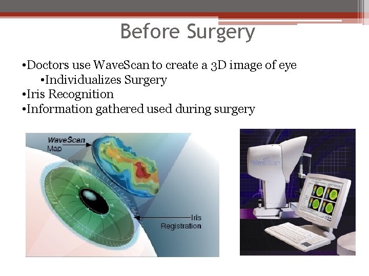 Wavefront Guided LASIK Eye Surgery Vi Tran BME