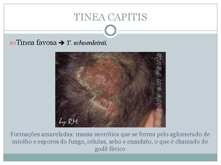 Dermatofitoses RESIDNCIA EM PEDIATRIA DO HOSPITAL REGIONAL DA