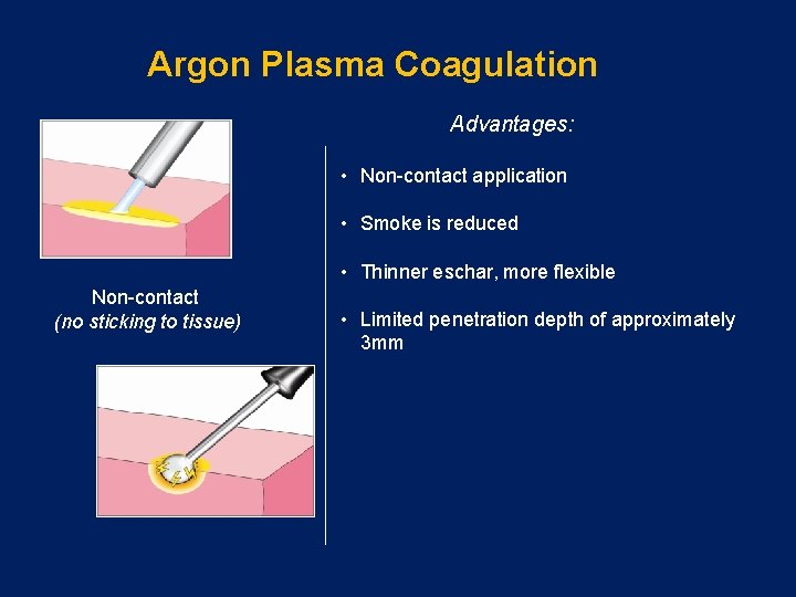 Egd With Argon Beam Coagulation Cpt Code - The Best Picture Of Beam