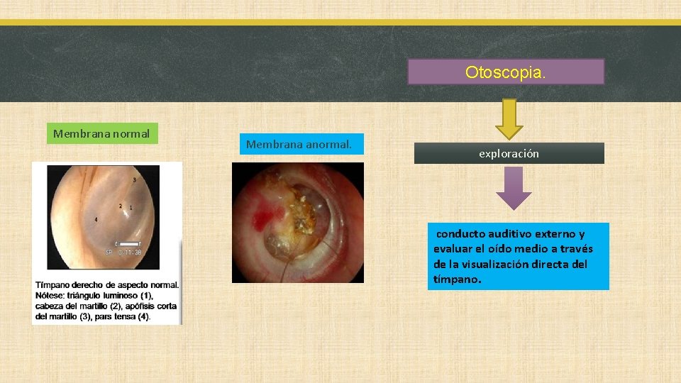 OTITIS MEDIA CRNICA CASO CLNICO Biologa Celular y