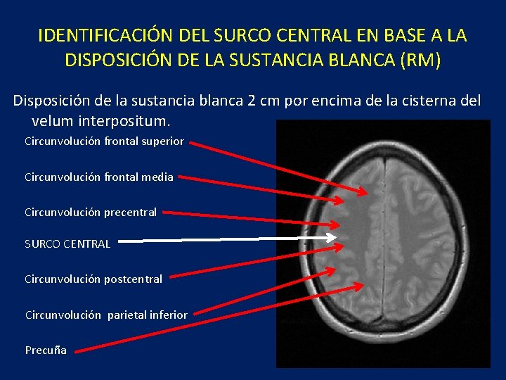 HALLAZGOS RADIOLOGICOS EN LA IDENTIFICACIN DEL SURCO CENTRAL