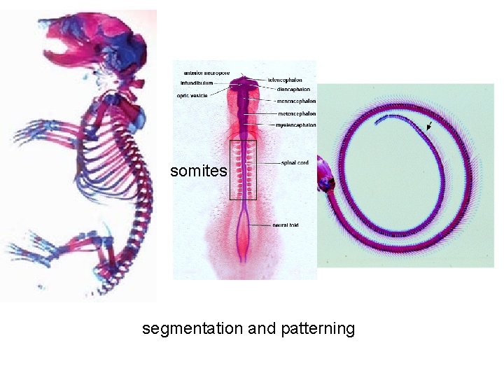 Human Embryology somites segmentation and patterning congenital ...