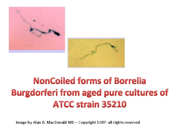 Borrelia Spirochetes imaged from Human blood Case studies