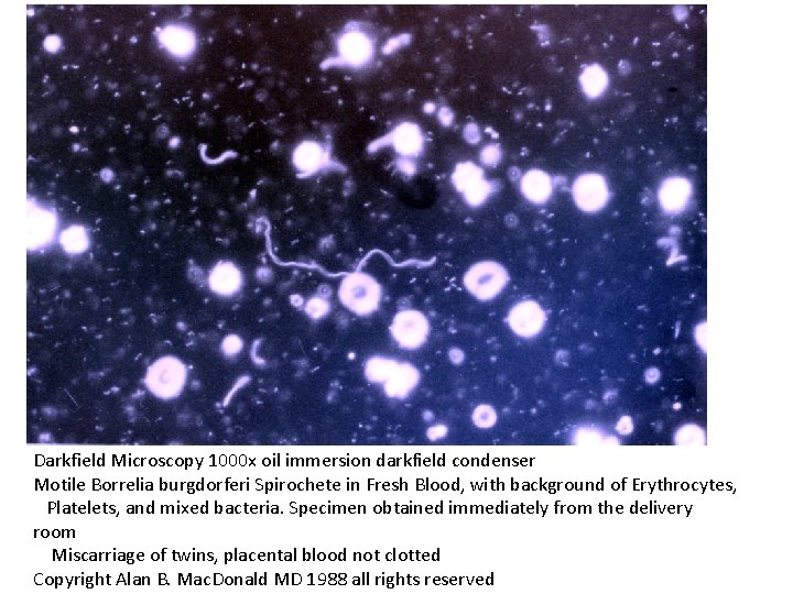 Borrelia Spirochetes imaged from Human blood Case studies