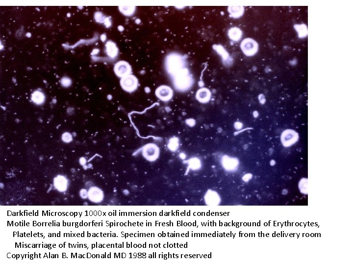Borrelia Spirochetes imaged from Human blood Case studies