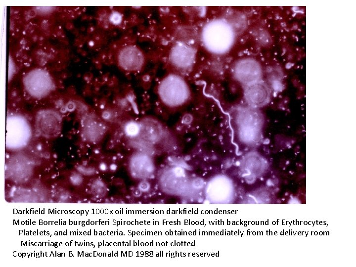 Borrelia Spirochetes imaged from Human blood Case studies