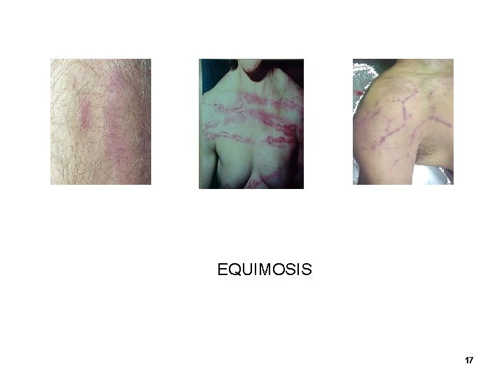 MEDICINA LEGAL Y ETICA MEDICA SUMARIO Traumatologa forense