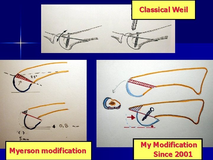 The Failed Hallux Valgus Instructionnal Course Lecture Canadian