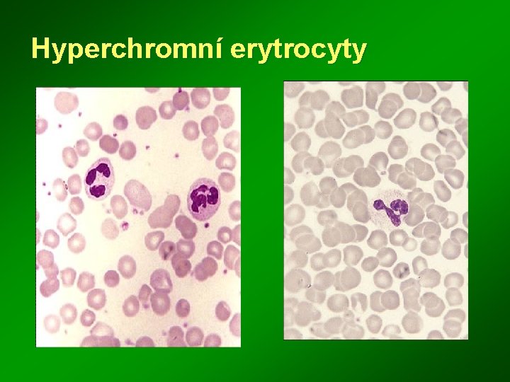 Morfologie erytrocyt Bourkov L Matkov M Hoblov J