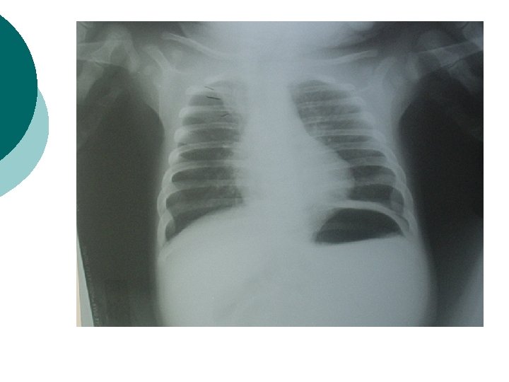 Respiratory Syncytial Virus Bronchiolitis in Infants Amanda Snodgrass