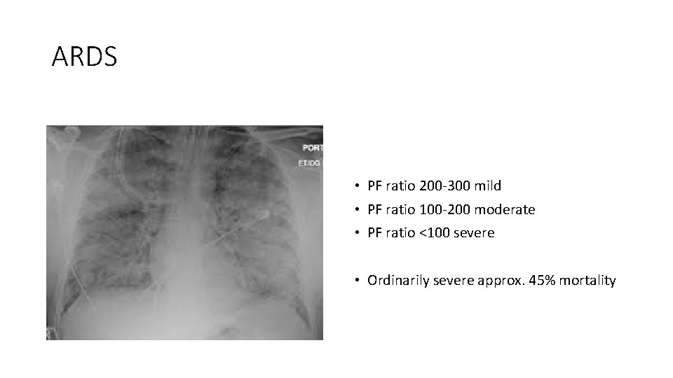 Covid 19 ICU Management Symptoms Cough Fever Sputum