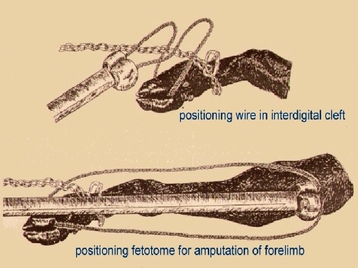 Fetotomy One of the most valuable obstetrical technique