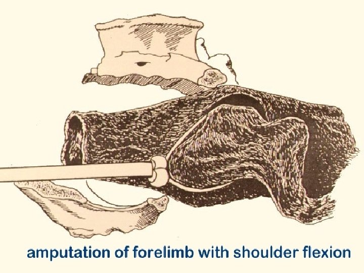 Fetotomy One of the most valuable obstetrical technique