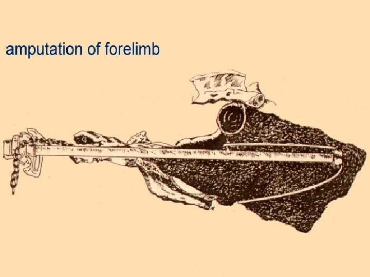 Fetotomy One of the most valuable obstetrical technique