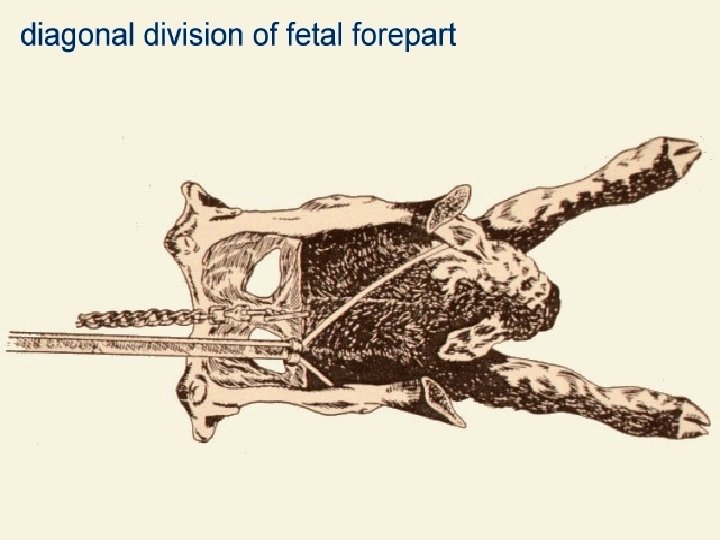 Fetotomy One of the most valuable obstetrical technique