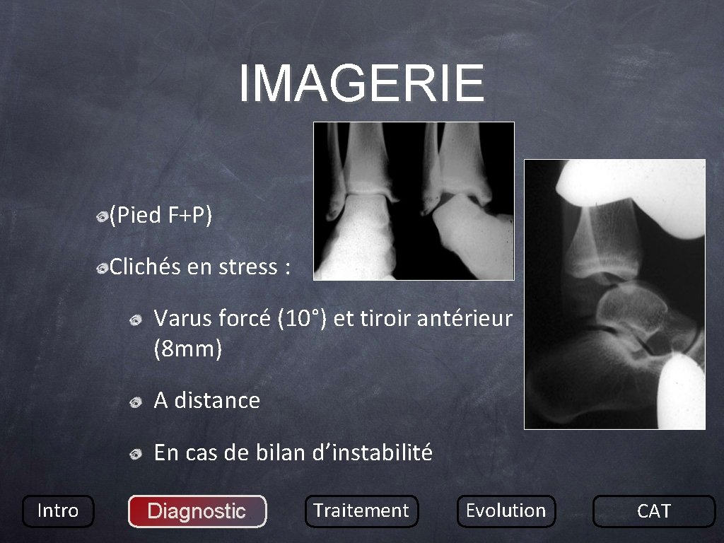 ENTORSES DE LA CHEVILLE EPIDEMIOLOGIE Urgence traumatique la