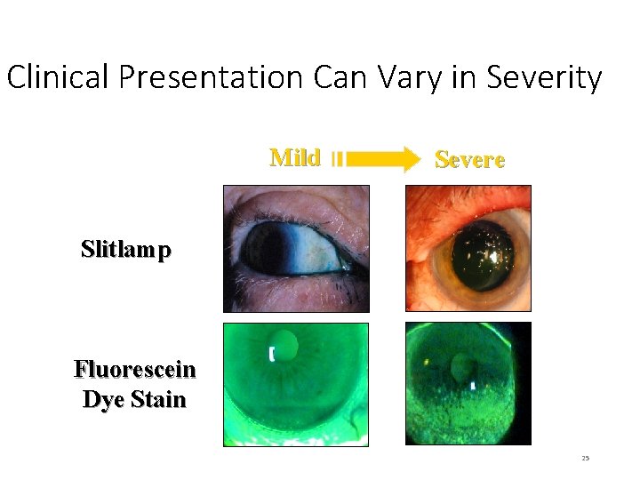 Dry Eye Dr Ajai Agrawal Additional Professor Department