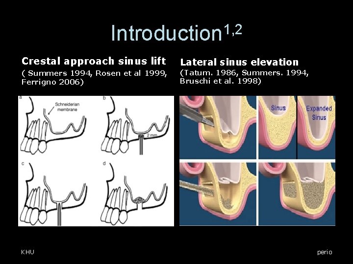 Anatomical consideration of Lateral Sinus elevation 2013 04