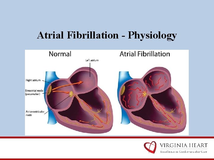 Cardiac Issues Atrial fibrillation Pacemakers Stents and Rehab