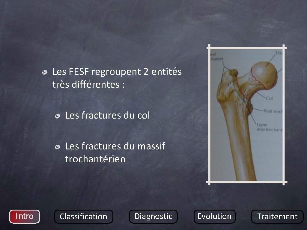FRACTURES DE LEXTREMITE SUPERIEURE DU FEMUR Chez ladulte