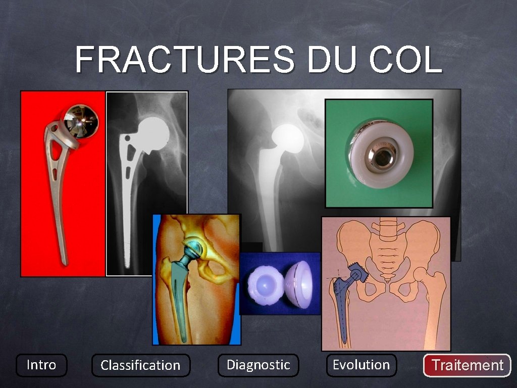 FRACTURES DE LEXTREMITE SUPERIEURE DU FEMUR Chez ladulte