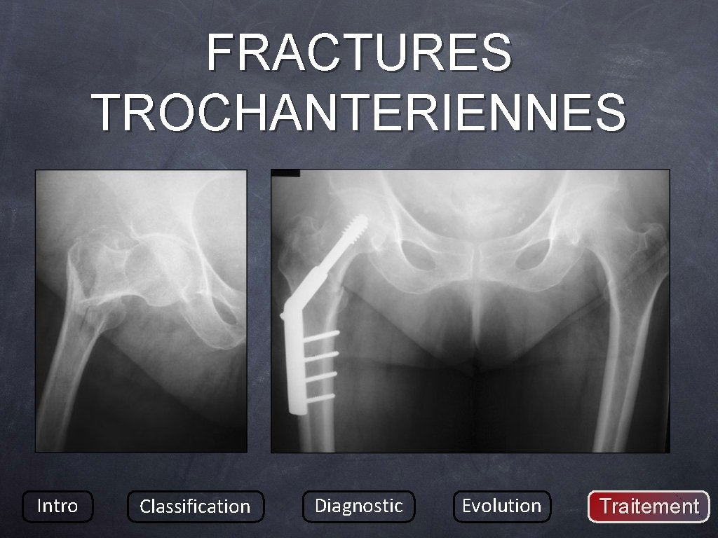FRACTURES DE LEXTREMITE SUPERIEURE DU FEMUR Chez ladulte