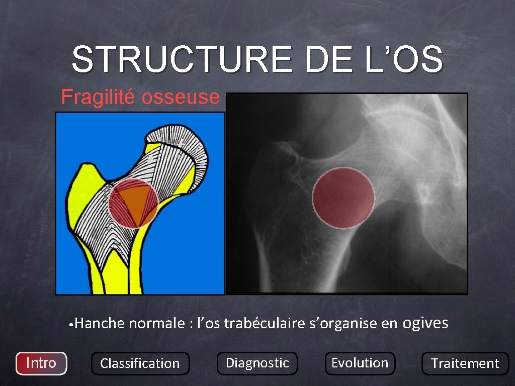 FRACTURES DE LEXTREMITE SUPERIEURE DU FEMUR Chez ladulte