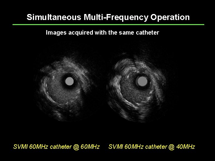 High Definition HD IVUS A New Approach to