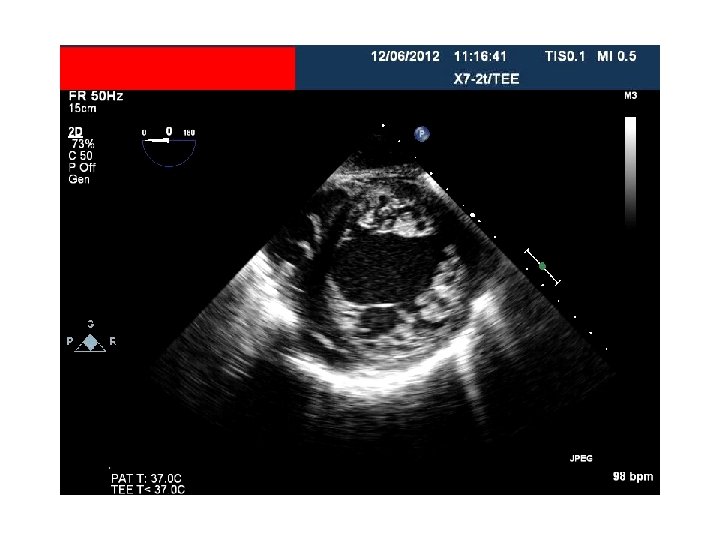 Temporary Devices as Bridge to More Permanent MCS