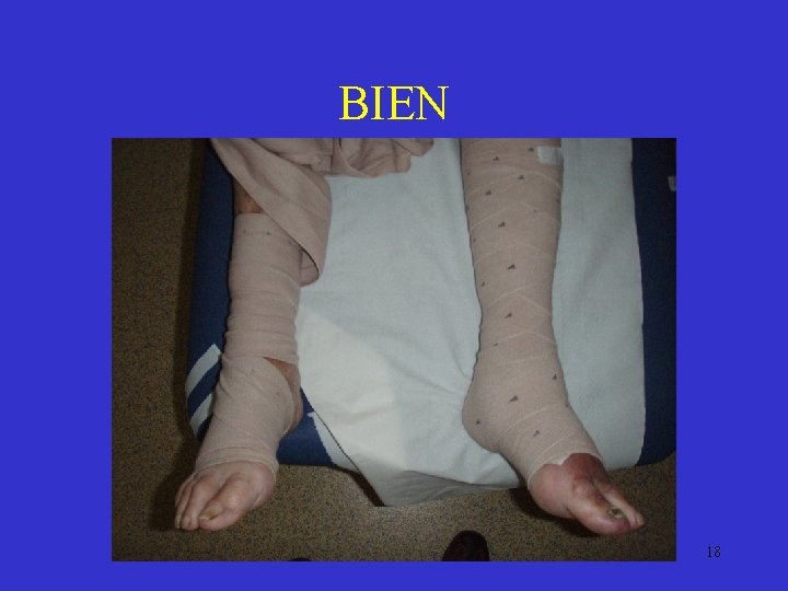 CONTENTION COMPRESSION Dr TERRUSSOT JP 1 Dfinitions Compression