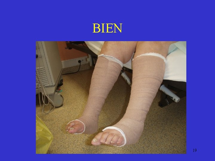 CONTENTION COMPRESSION Dr TERRUSSOT JP 1 Dfinitions Compression