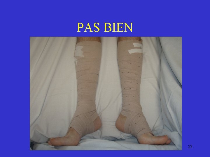 CONTENTION COMPRESSION Dr TERRUSSOT JP 1 Dfinitions Compression