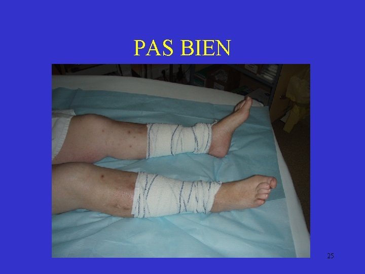 CONTENTION COMPRESSION Dr TERRUSSOT JP 1 Dfinitions Compression