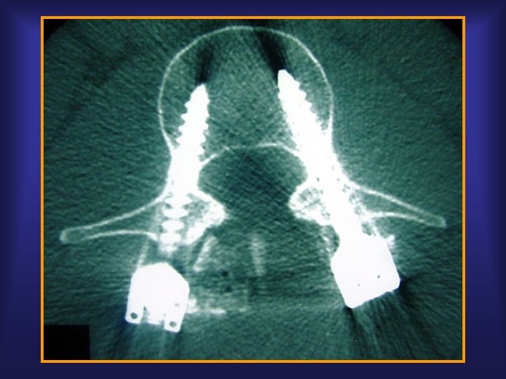 La vise pdiculaire Richard ASSAKER DES Mars 2002