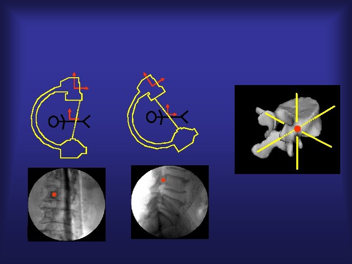 La vise pdiculaire Richard ASSAKER DES Mars 2002