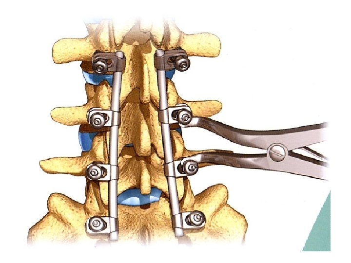 La vise pdiculaire Richard ASSAKER DES Mars 2002