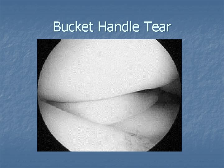 Meniscal Tears and Their Treatment Should I Refer