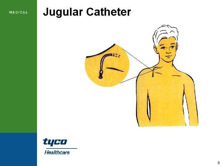 Dialysis Access 1 Vascular System Superior Vena Cava