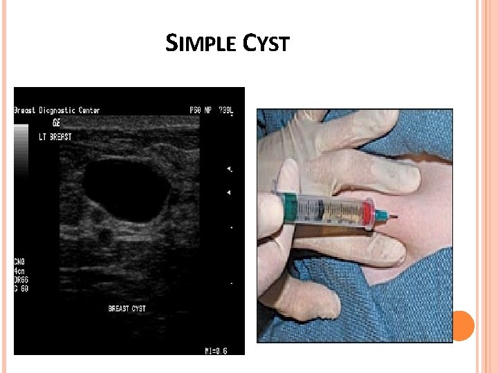BENIGN BREAST DISEASE Dr Amit Gupta Associate Professor