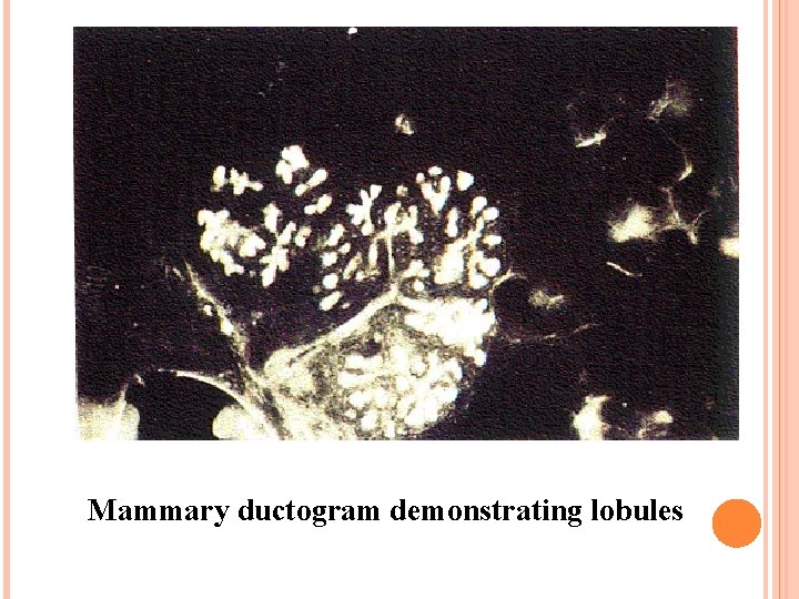 BENIGN BREAST DISEASE Dr Amit Gupta Associate Professor