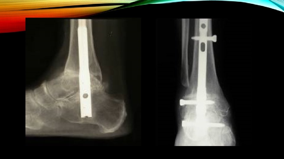 SURGICAL MANAGEMENT OF FOOT AND ANKLE ARTHRITIS Verity