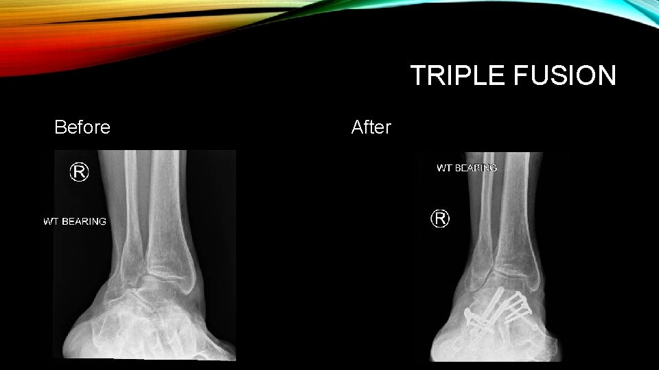 SURGICAL MANAGEMENT OF FOOT AND ANKLE ARTHRITIS Verity
