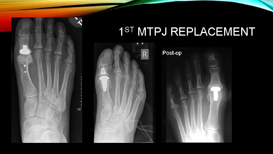 SURGICAL MANAGEMENT OF FOOT AND ANKLE ARTHRITIS Verity