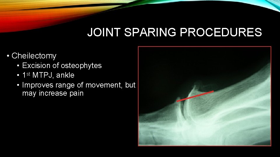 SURGICAL MANAGEMENT OF FOOT AND ANKLE ARTHRITIS Verity