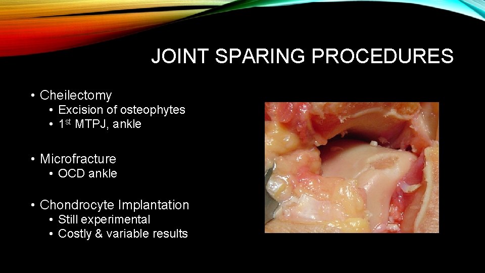SURGICAL MANAGEMENT OF FOOT AND ANKLE ARTHRITIS Verity