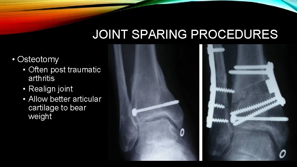 SURGICAL MANAGEMENT OF FOOT AND ANKLE ARTHRITIS Verity