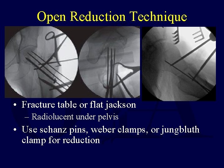 Femoral Neck Fractures Carol Lin MD Brad Merk