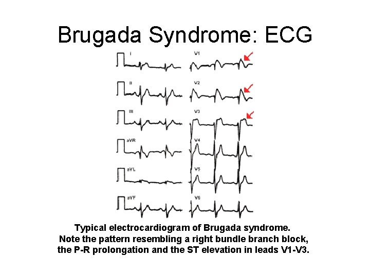 Brugadas Syndrome and Sudden Cardiac Death Petra Lovrec