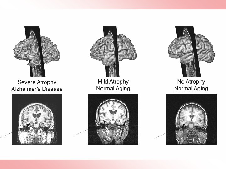 Aging of the Nervous System Structural Changes Chapters