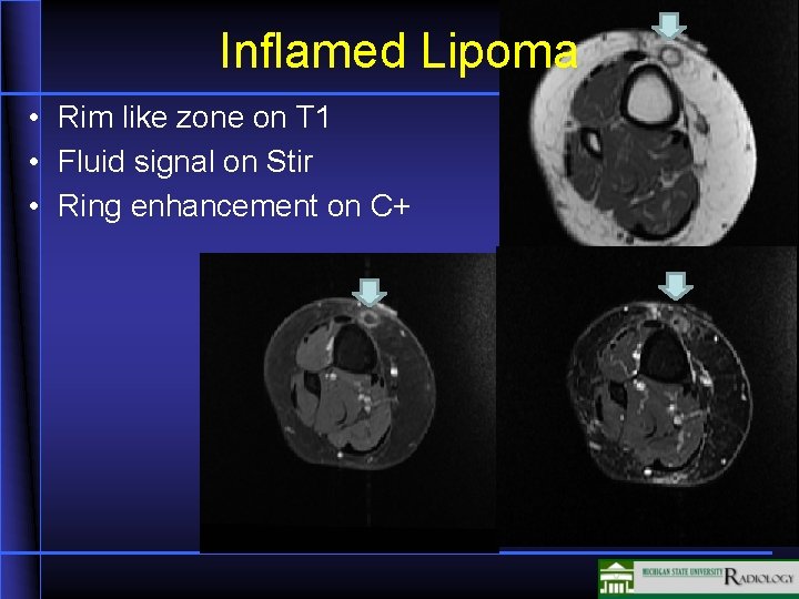 Soft Tissue Inflammatory Disease Soft Tissue Inflammatory Multiple